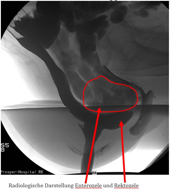 Erkrankungen des Beckenbodens