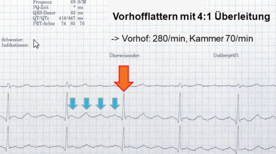 Diagnose und Therapie von Herzrhythmusstörungen mit dem Katheter ...