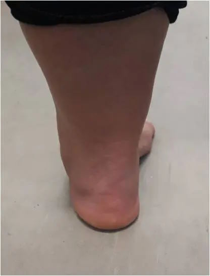 Hohlfuß (Pes cavo-varus)