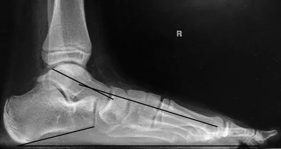 Kindlicher Pes planovalgus (Knick-Senkfuß)