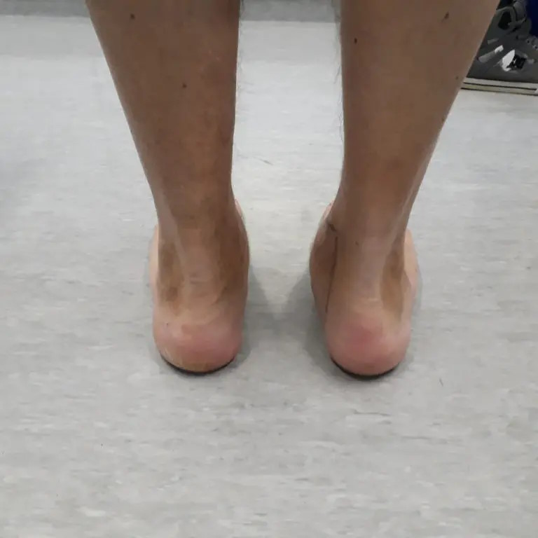 Kindlicher Pes planovalgus (Knick-Senkfuß)