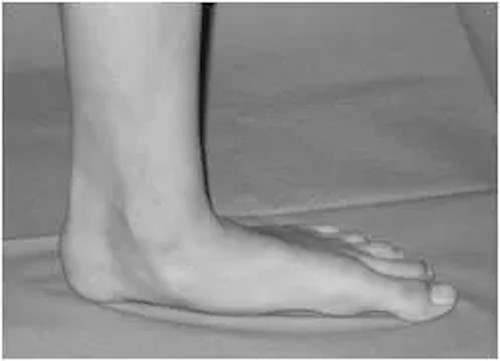 Kindlicher Pes planovalgus (Knick-Senkfuß)