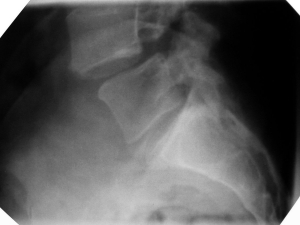 Spondylolisthesis (Wirbelgleiten)