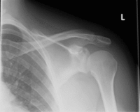 Schultereckgelenksverschleiß (ACG-Arthrose)