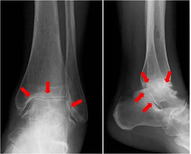 OSG Arthrose: Arthrose des oberen Sprunggelenkes