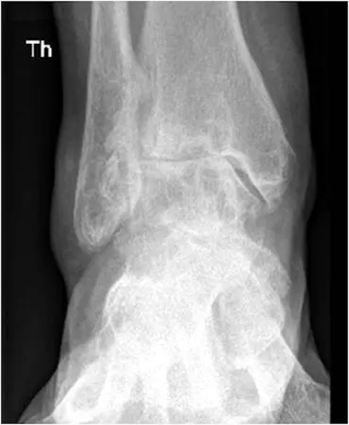 OSG Arthrose: Arthrose des oberen Sprunggelenkes