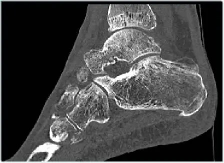 OSG Arthrose: Arthrose des oberen Sprunggelenkes