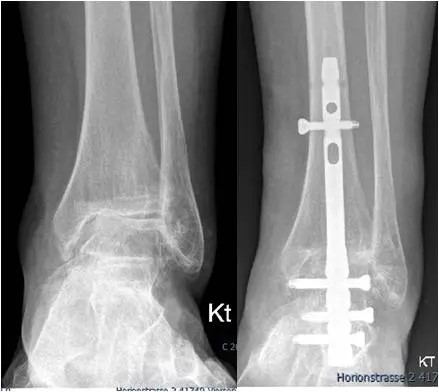 OSG Arthrose: Arthrose des oberen Sprunggelenkes