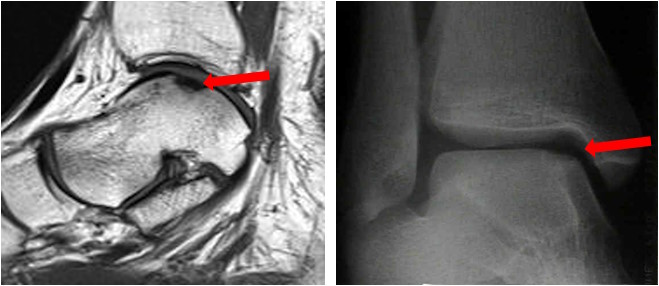 Knorpel-Knochen-Defekte des oberen Sprunggelenks: Osteochondrosis ...