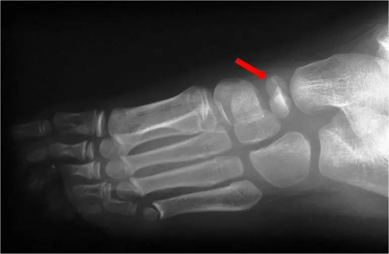 Morbus Köhler I und II
